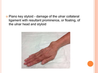 Approach to and recent advances in management of rheumatoid arthritis | PPT