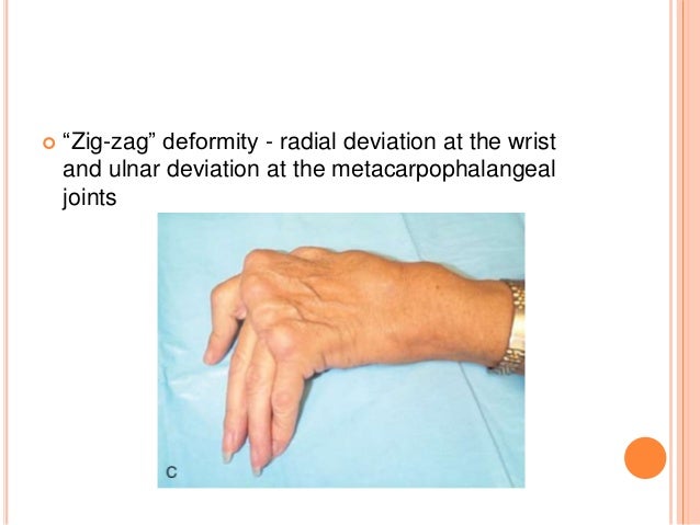 Approach to and recent advances in management of rheumatoid arthritis