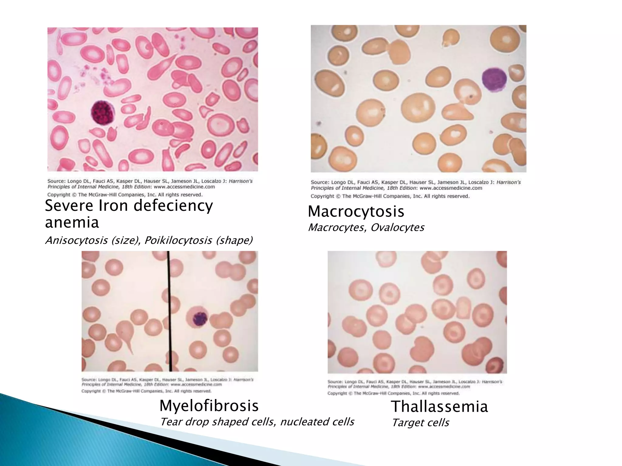 Approach to Anemia | PPTX