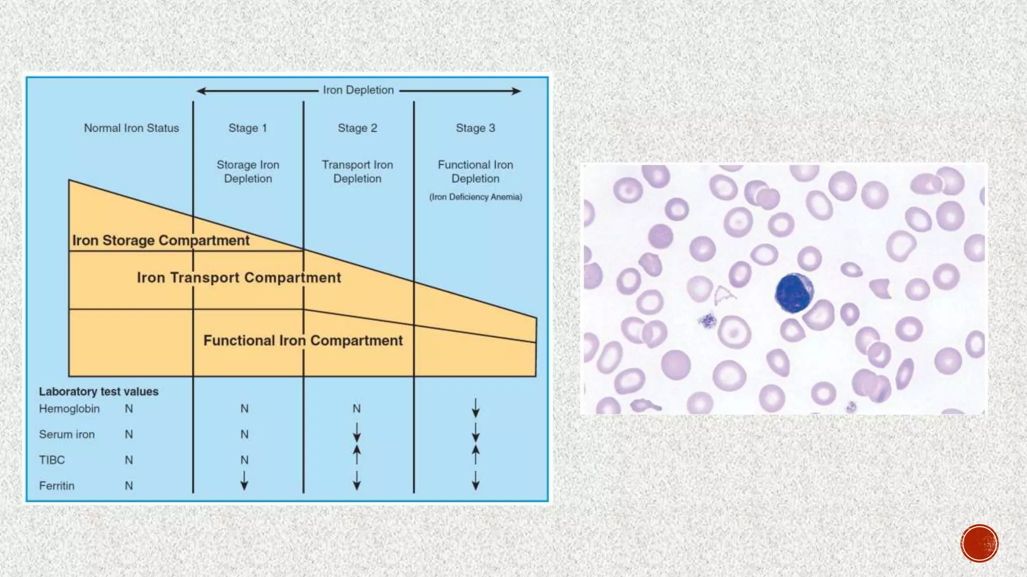 Approach to anemia | PPTX