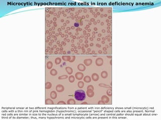 Approach to anemia | PPTX