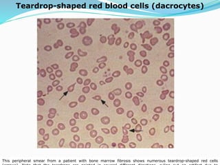 Approach to anemia | PPTX