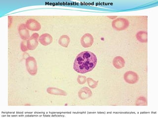 Approach to anemia | PPTX