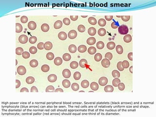 Approach to anemia | PPTX