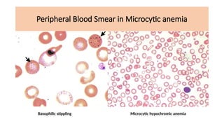 Approach to anemia based on Harrison's book | PPTX