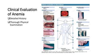 Approach to Anemia - Copy.pptx how to diagnose | PPT