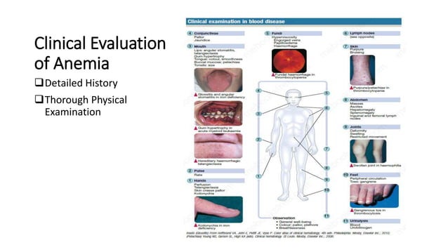 Approach to Anemia - Copy.pptx how to diagnose | PPT