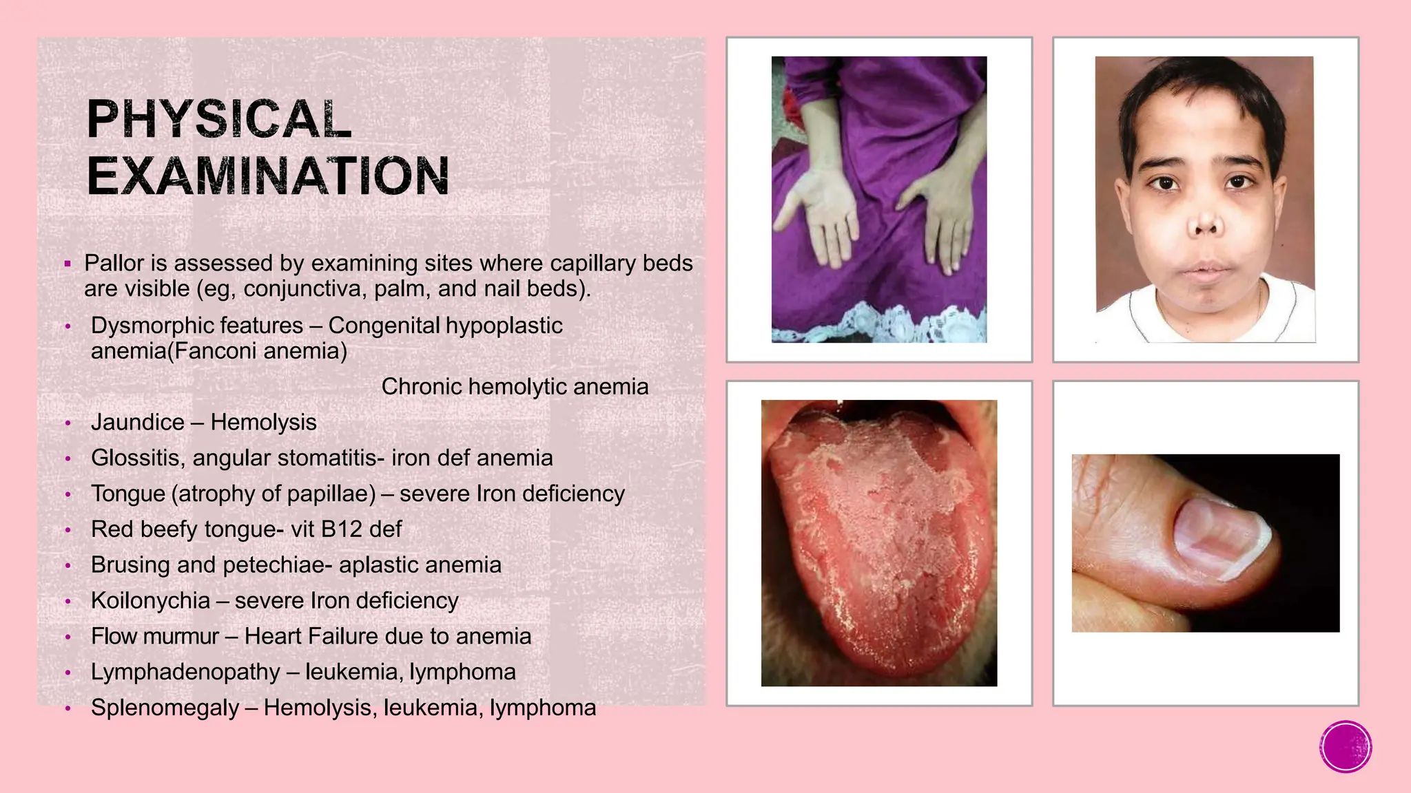 approach to anemia in children: IDA , MEGALOBLASTIC ANEMIA AND APLASTIC ...