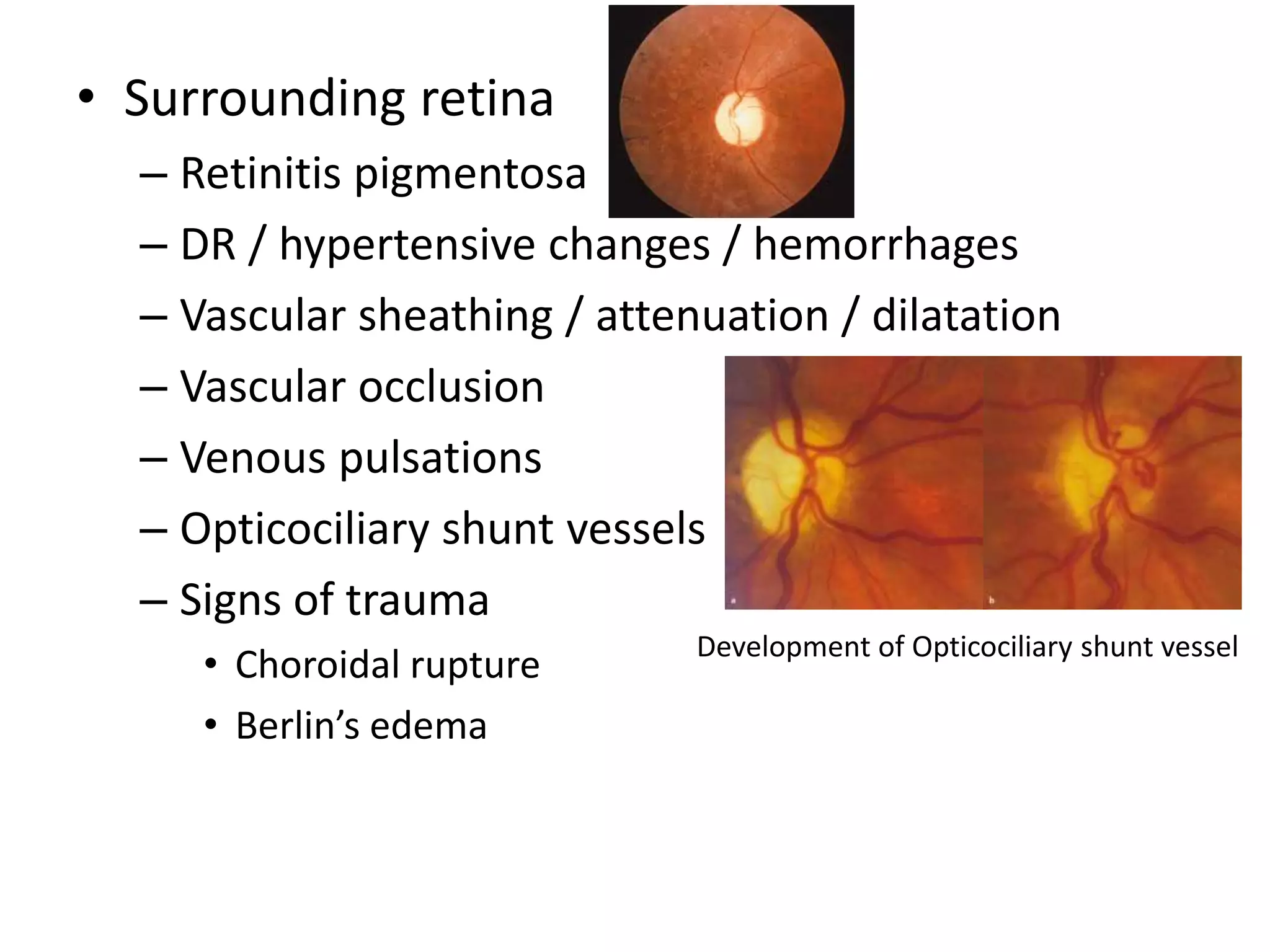 Approach to a pale optic disc | PPTX