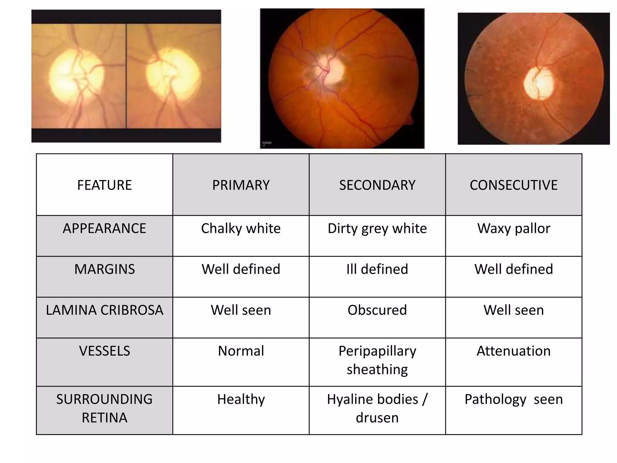 Approach to a pale optic disc | PPTX