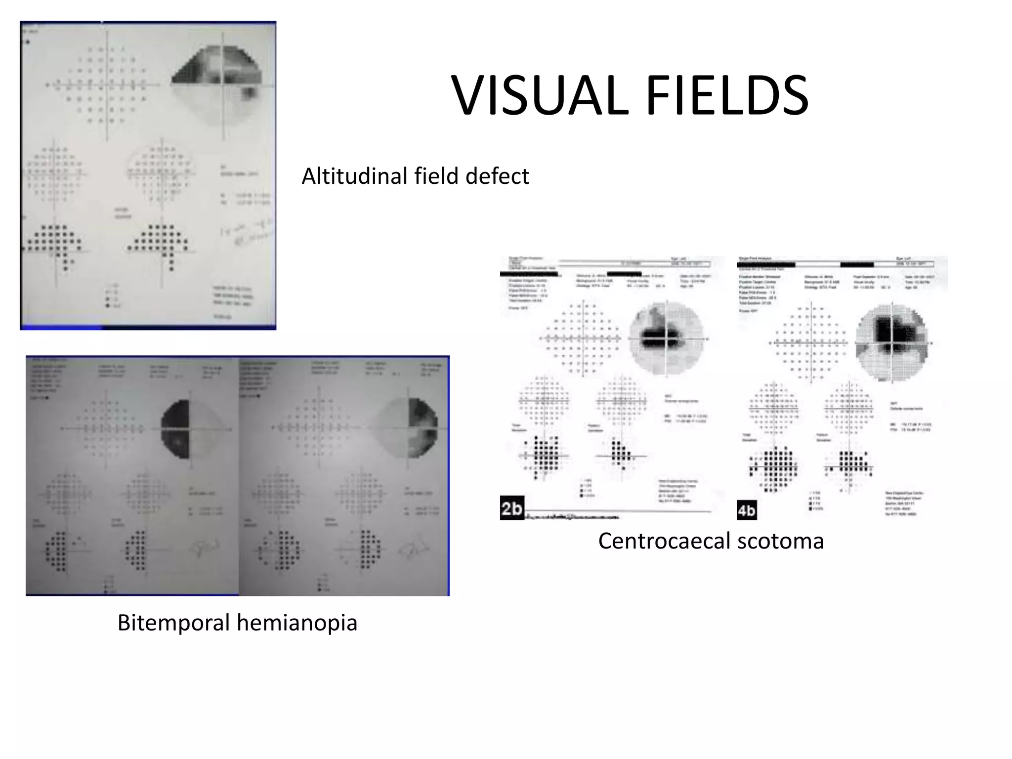 Approach to a pale optic disc | PPTX