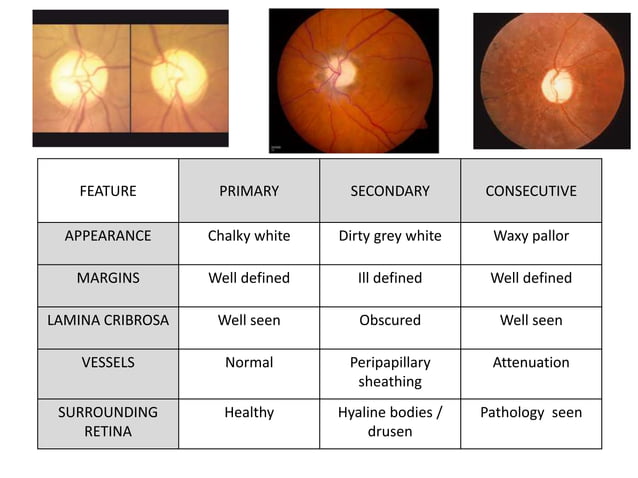 Approach to a pale optic disc | PPTX | Blood Disorders | Diseases and ...