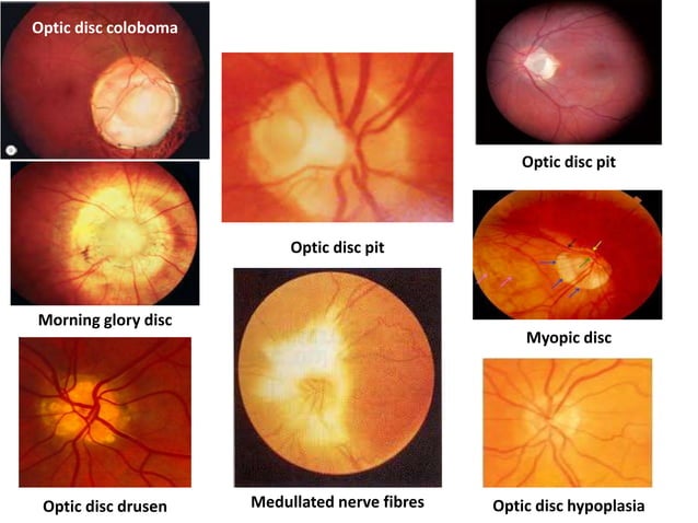 Approach to a pale optic disc | PPTX | Blood Disorders | Diseases and ...