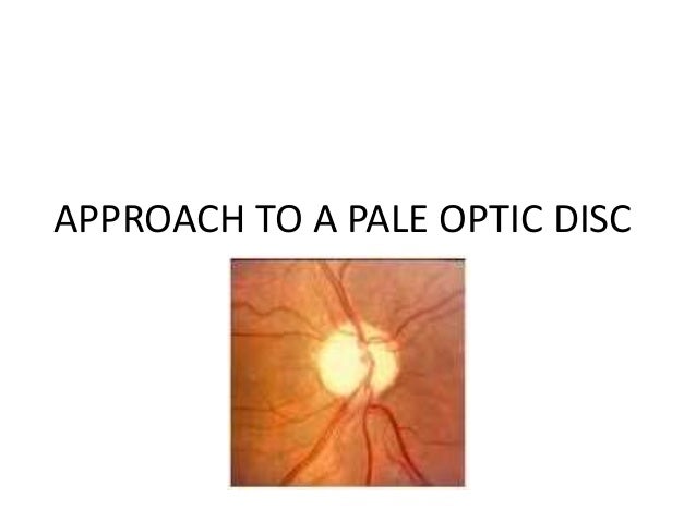 Approach to a pale optic disc