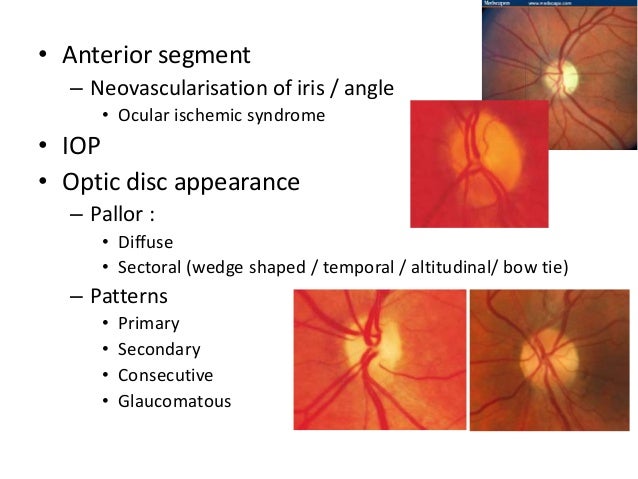 Approach to a pale optic disc