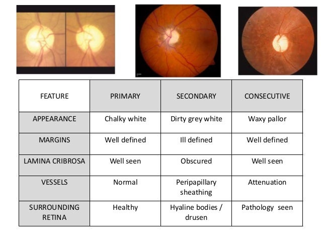 Approach to a pale optic disc