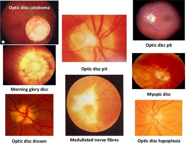 Tilted Optic Disc
