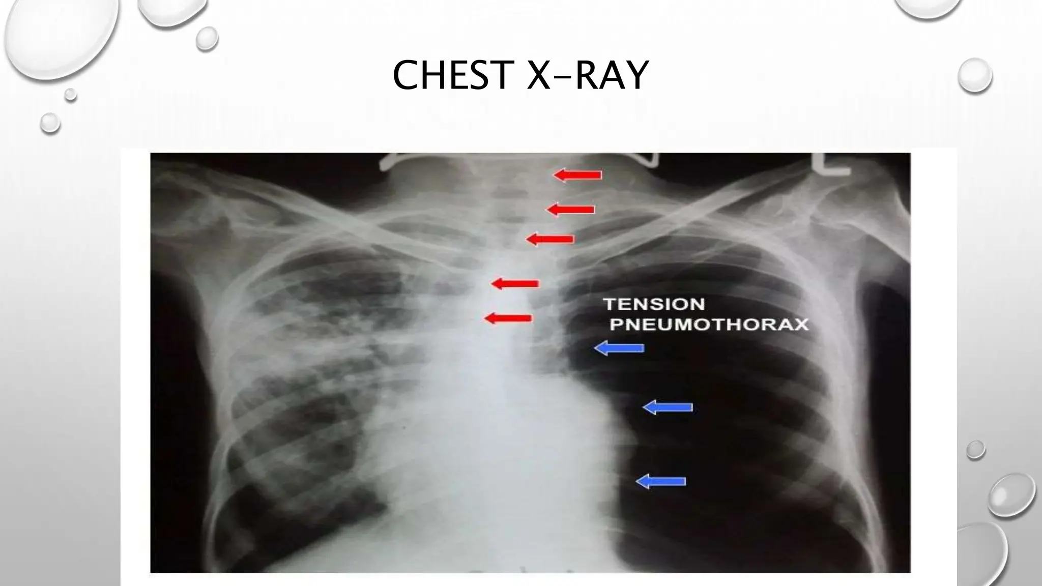 Approach to a patient of chest injury.pptx