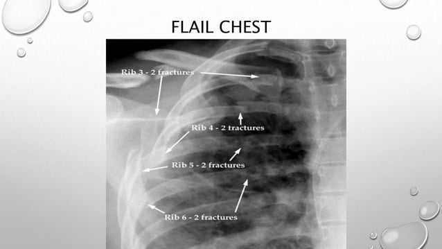 Approach to a patient of chest injury.pptx | Free Download