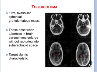Approach to a patient of neurological tuberculosis | PPTX