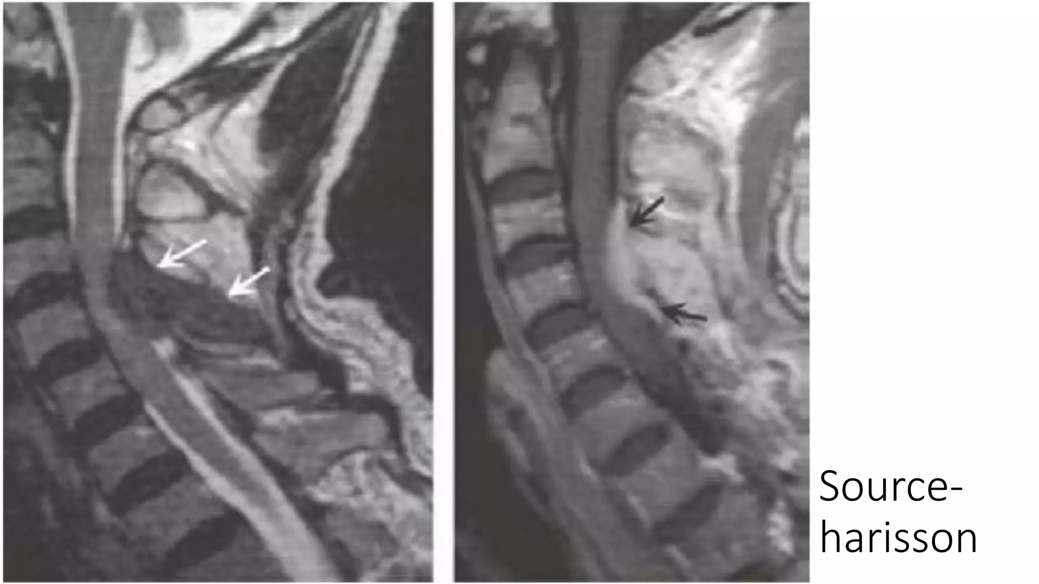 Approach to a patient of spastic paraplegia | PPTX
