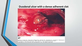 upper gastrointestinal bleeding | PPTX
