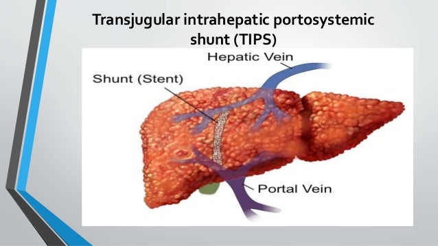upper gastrointestinal bleeding