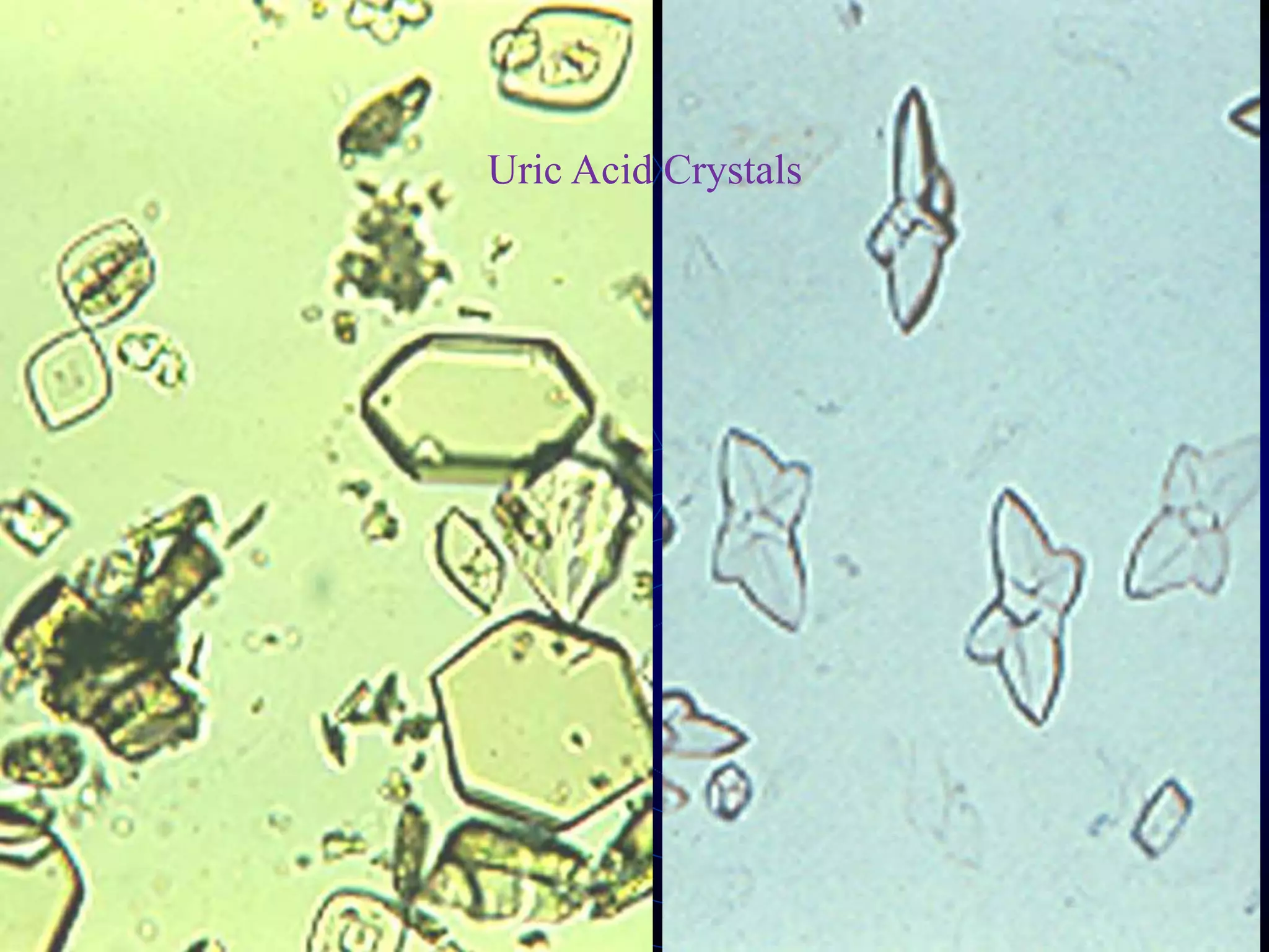 Approach to a patient with active urinary sediments | PPTX
