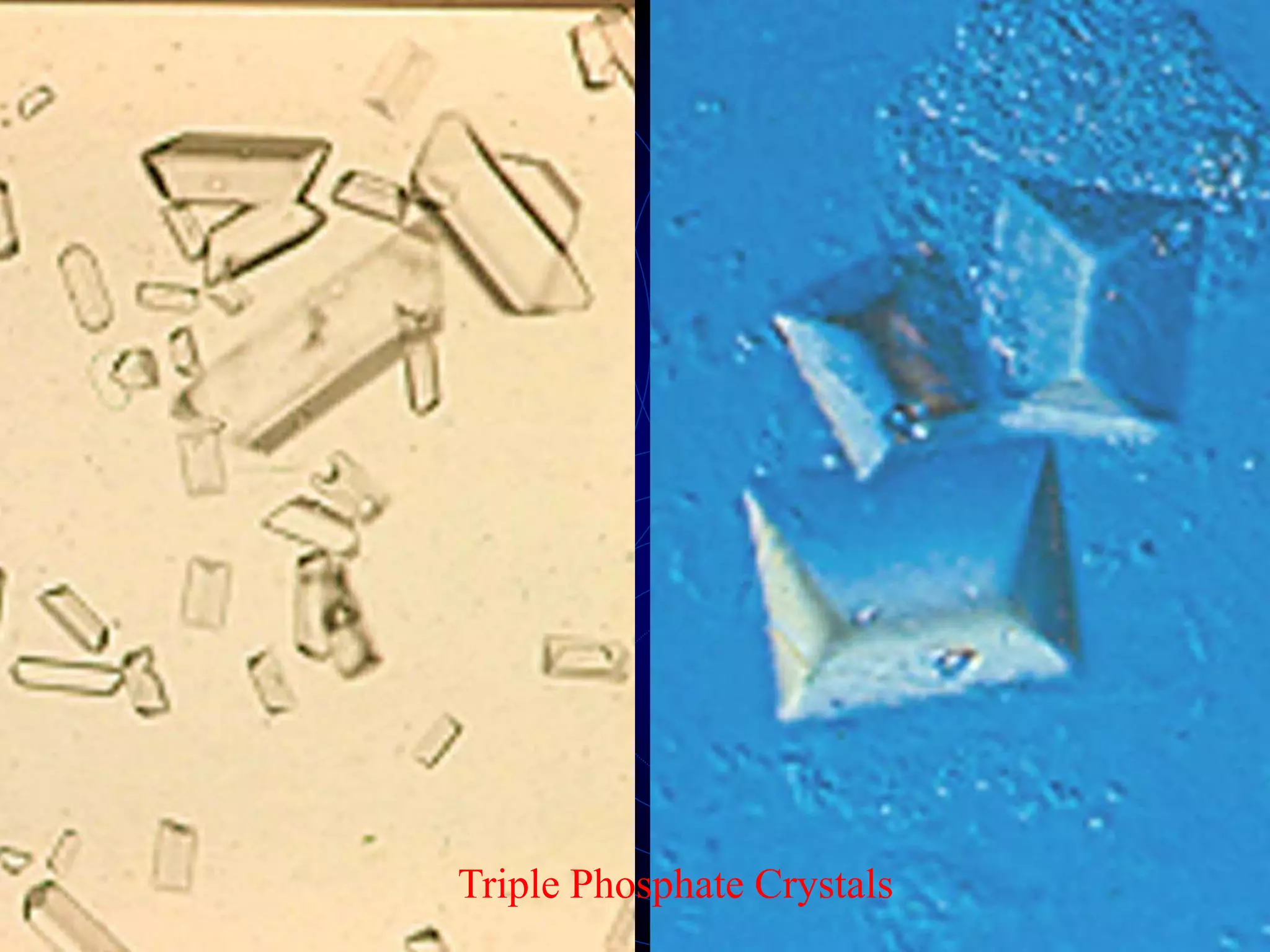 Approach to a patient with active urinary sediments | PPTX