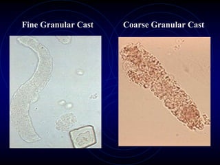 Granular Cast In Urine