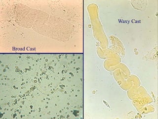 Broad Casts In Urine