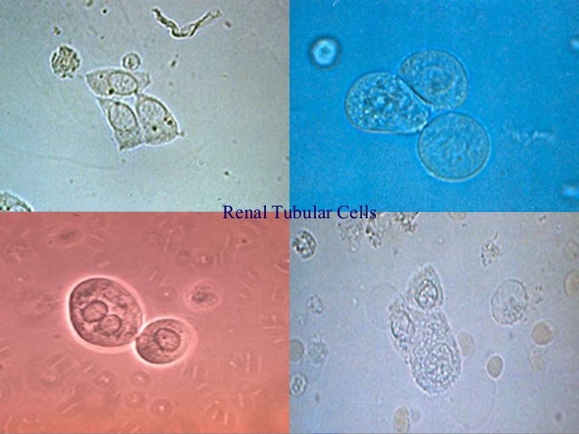 Approach to a patient with active urinary sediments