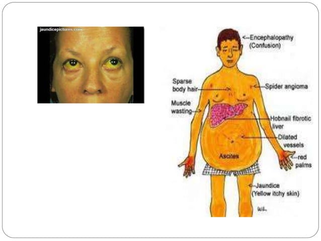 Approach to a patient with ascites | PPTX | Digestive Disorders ...