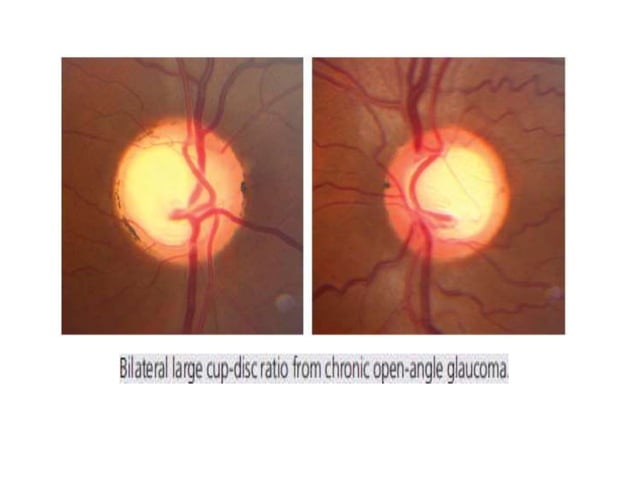 Approach to a patient with bilateral vision loss | PPT