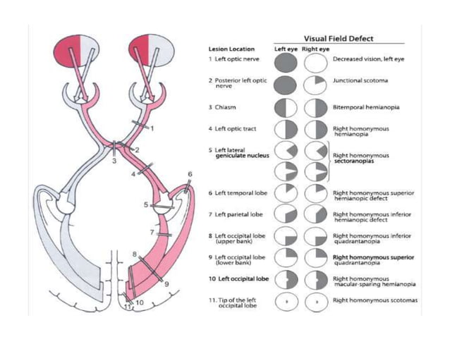 Approach to a patient with bilateral vision loss | PPT