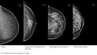 Approach to a patient with breast lump | PPTX