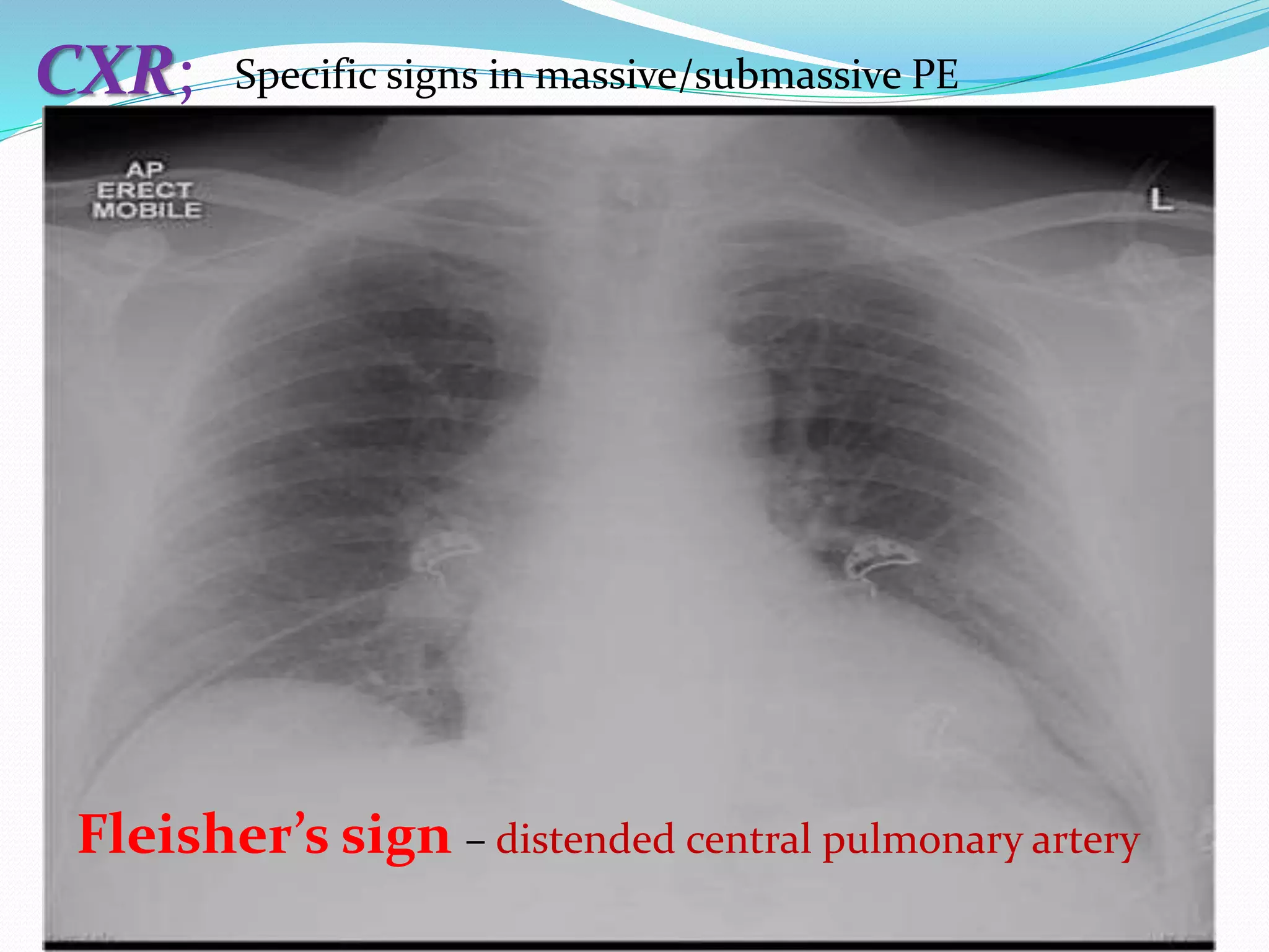 Approach to a patient with chest pain | PPTX