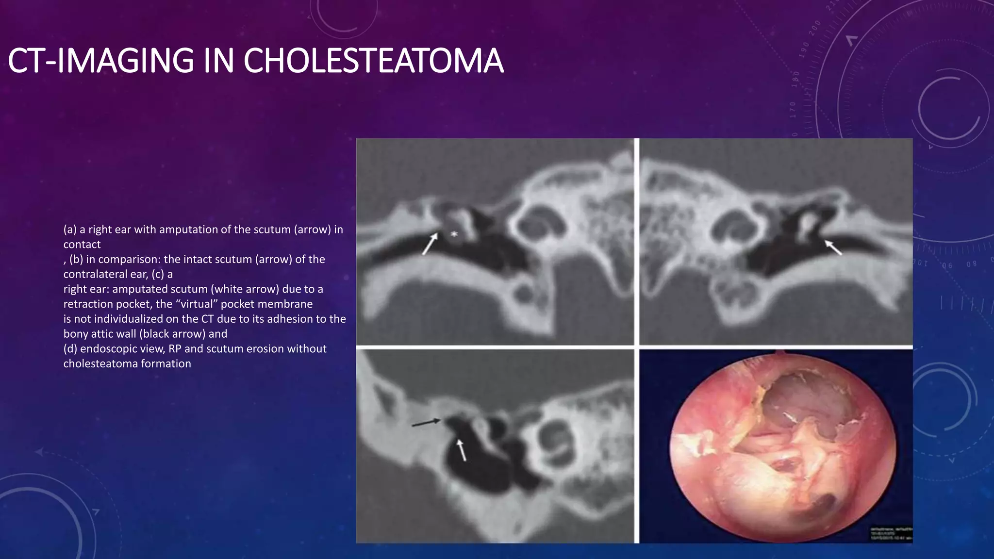 Approach to a patient with cholesteatoma | PPTX