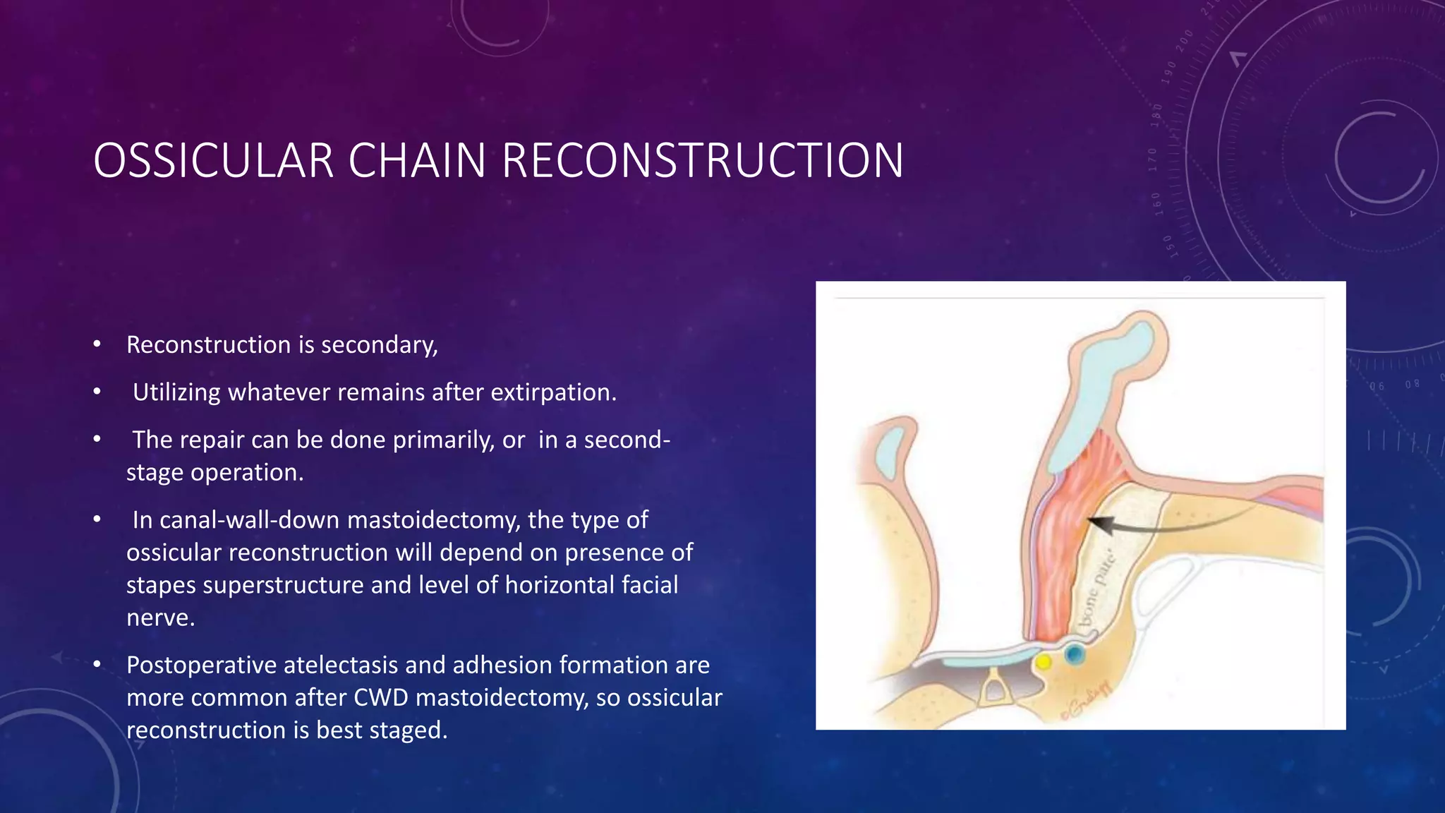 Approach to a patient with cholesteatoma | PPTX