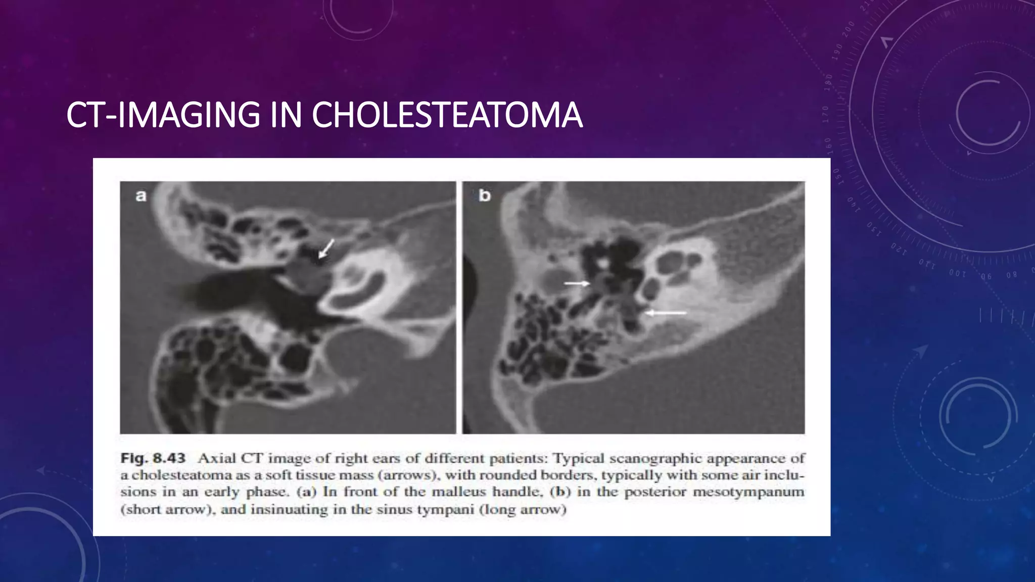 Approach to a patient with cholesteatoma | PPTX