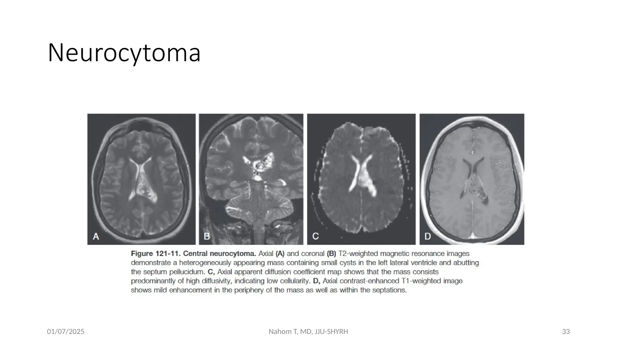 Approach to a patient with CNS tumor.pptx