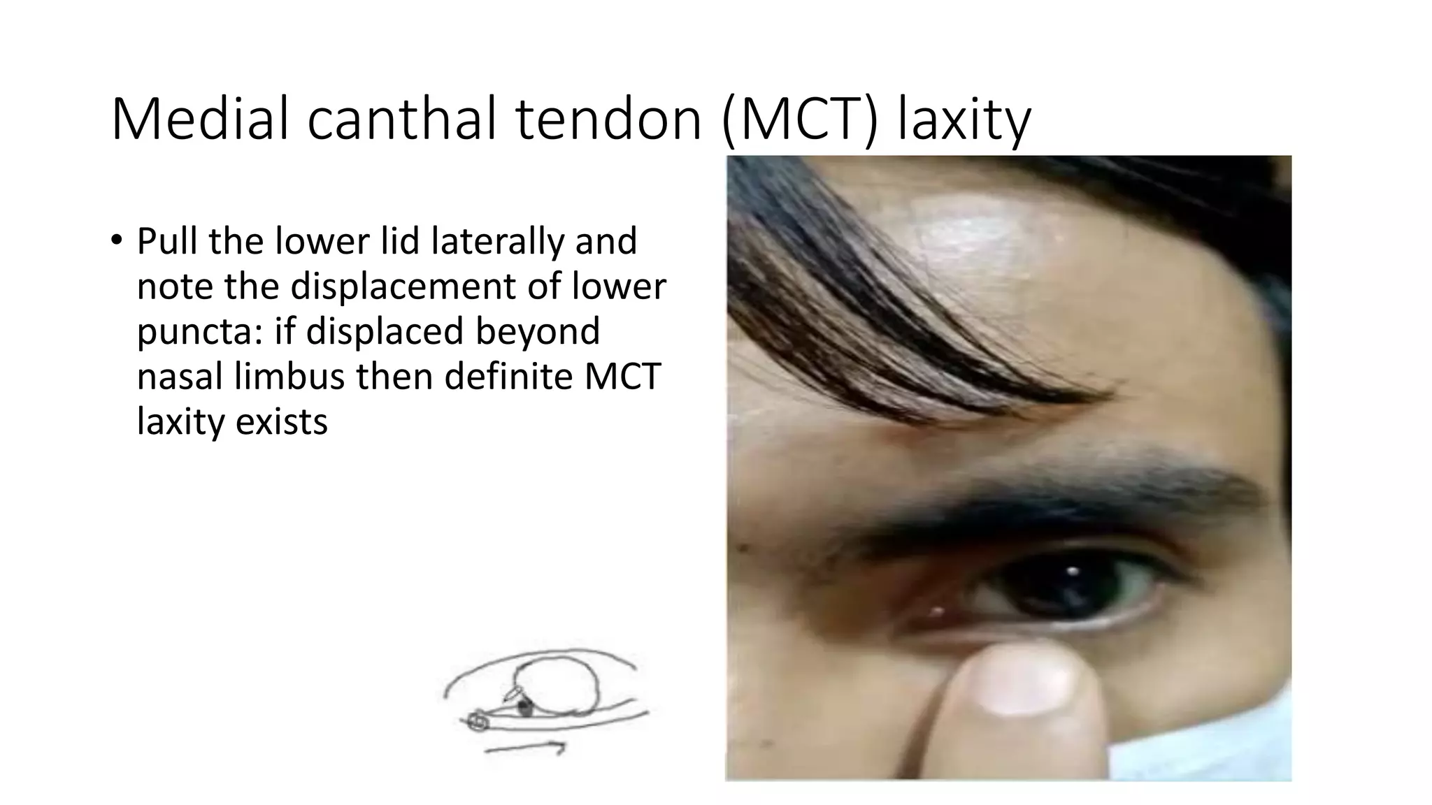 Approach to a patient with ectropion, entropion, symblepharon.pptx