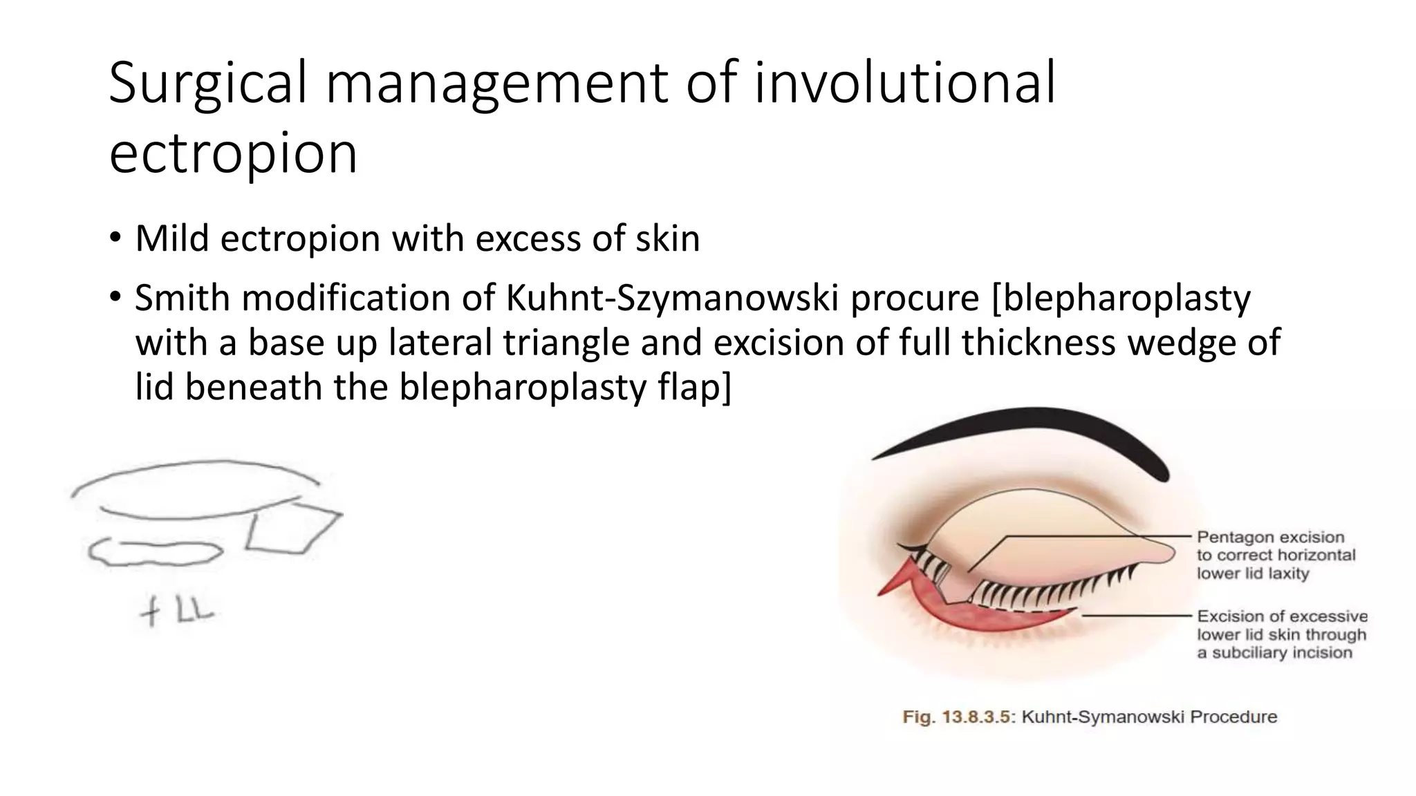 Approach to a patient with ectropion, entropion, symblepharon.pptx