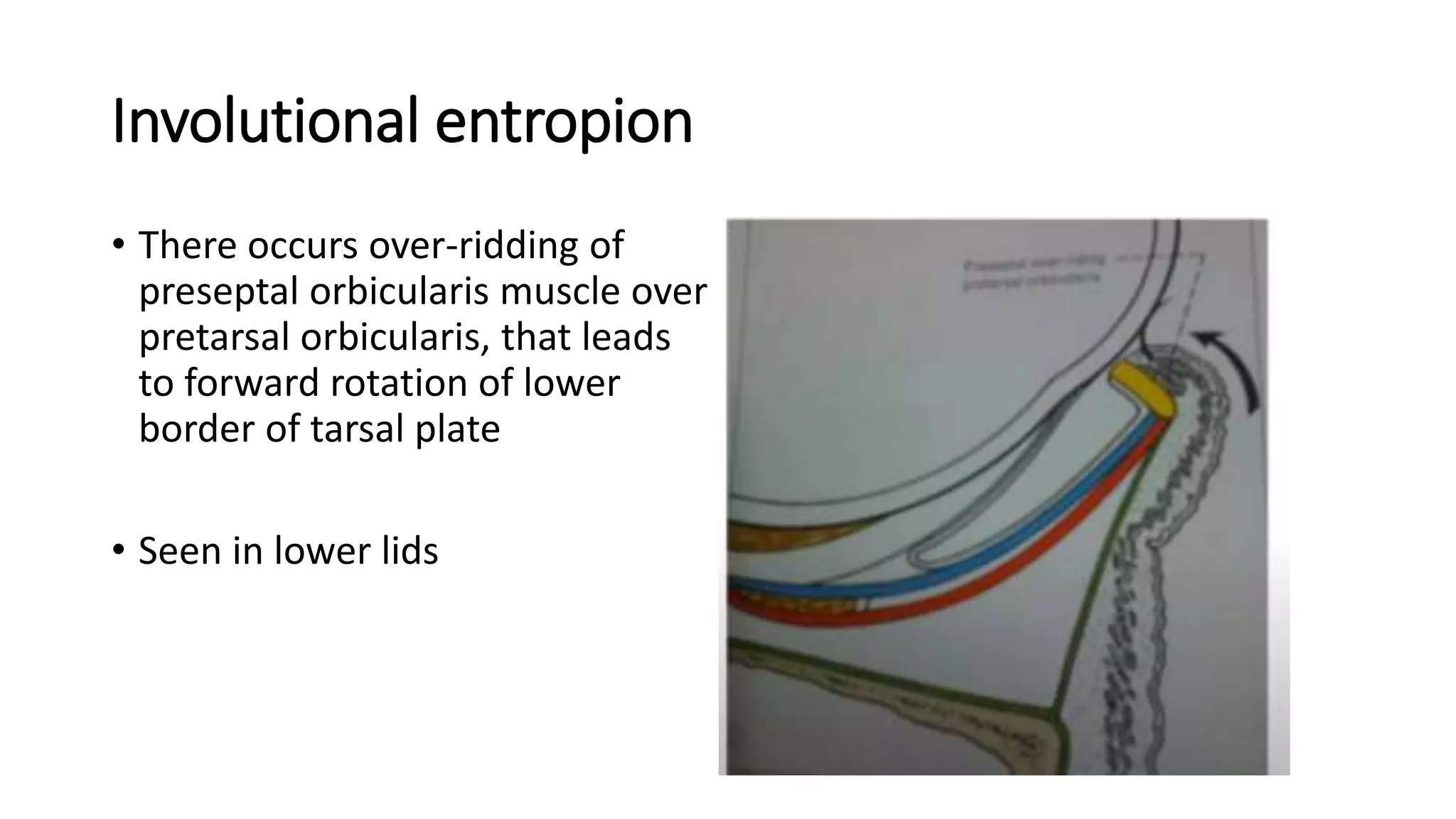 Approach to a patient with ectropion, entropion, symblepharon.pptx