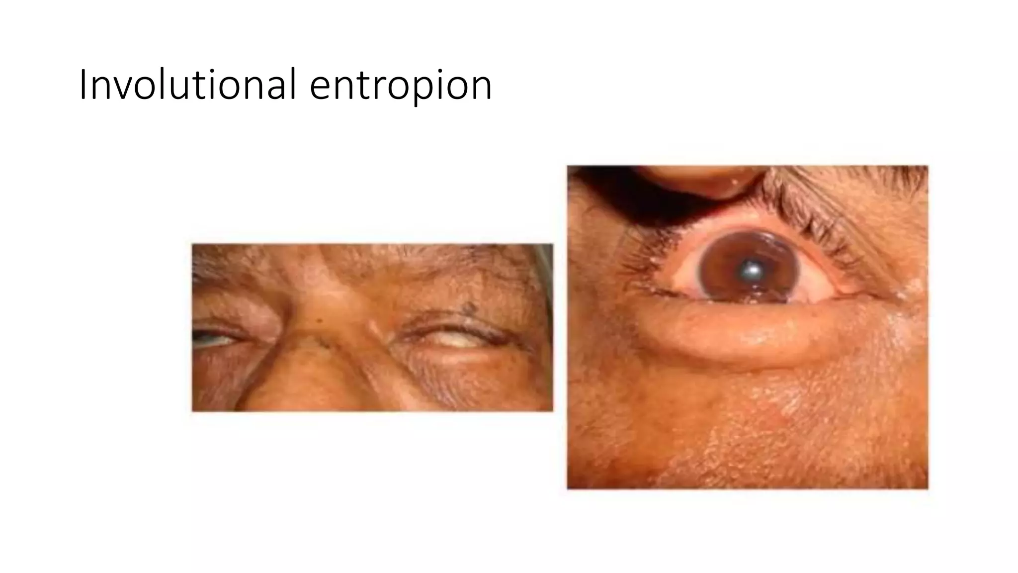 Approach to a patient with ectropion, entropion, symblepharon.pptx