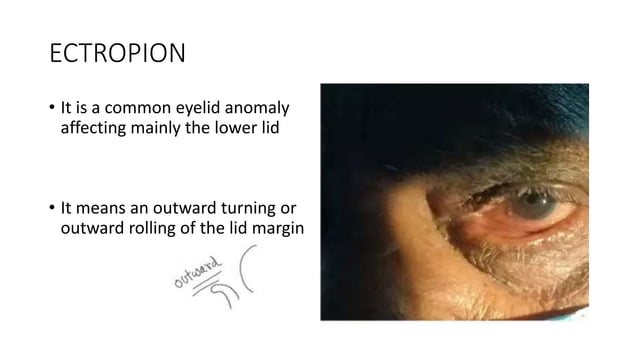 Approach to a patient with ectropion, entropion, symblepharon.pptx