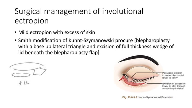 Approach to a patient with ectropion, entropion, symblepharon.pptx