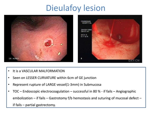 Approach to a patient with GI hemorrhage | PPT