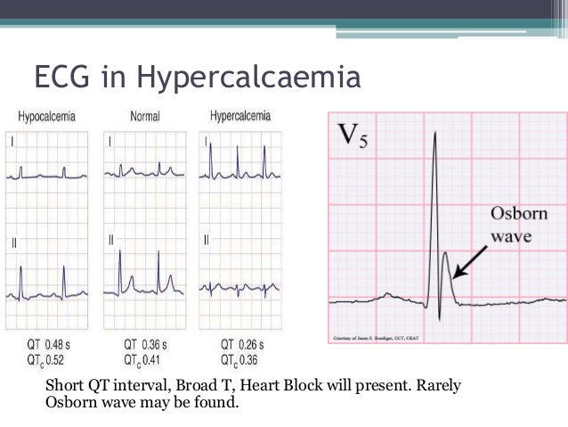 Approach to a patient with hypercalcaemia