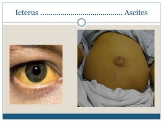 Approach To A Patient With Jaundice | PPTX